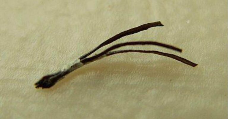 Pili Multigemini: Causes, Risk Factors, and Treatment - Ulike